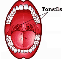 What is a Tonsil Stone? Causes and Symptoms of tonsillitis - Natural ...