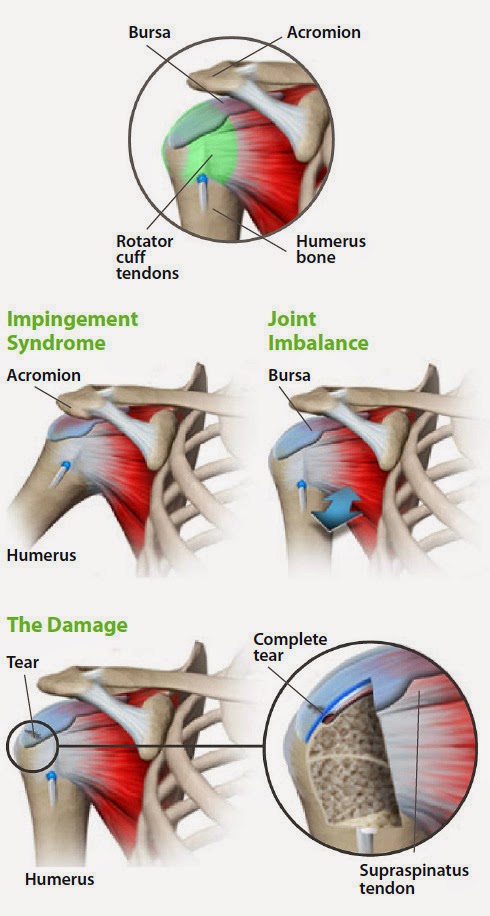 MyPhysiocare - Physiotherapy patient education: Injured Rotator Cuff of ...