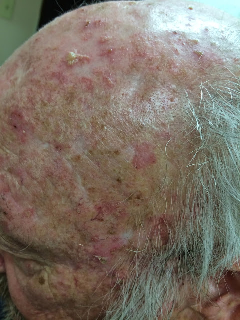 What is meant by “pre-skin cancer”? Actinic keratosis