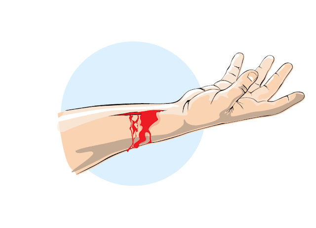 Haemorrhage or bleeding , type of haemorrhage or control of bleeding
