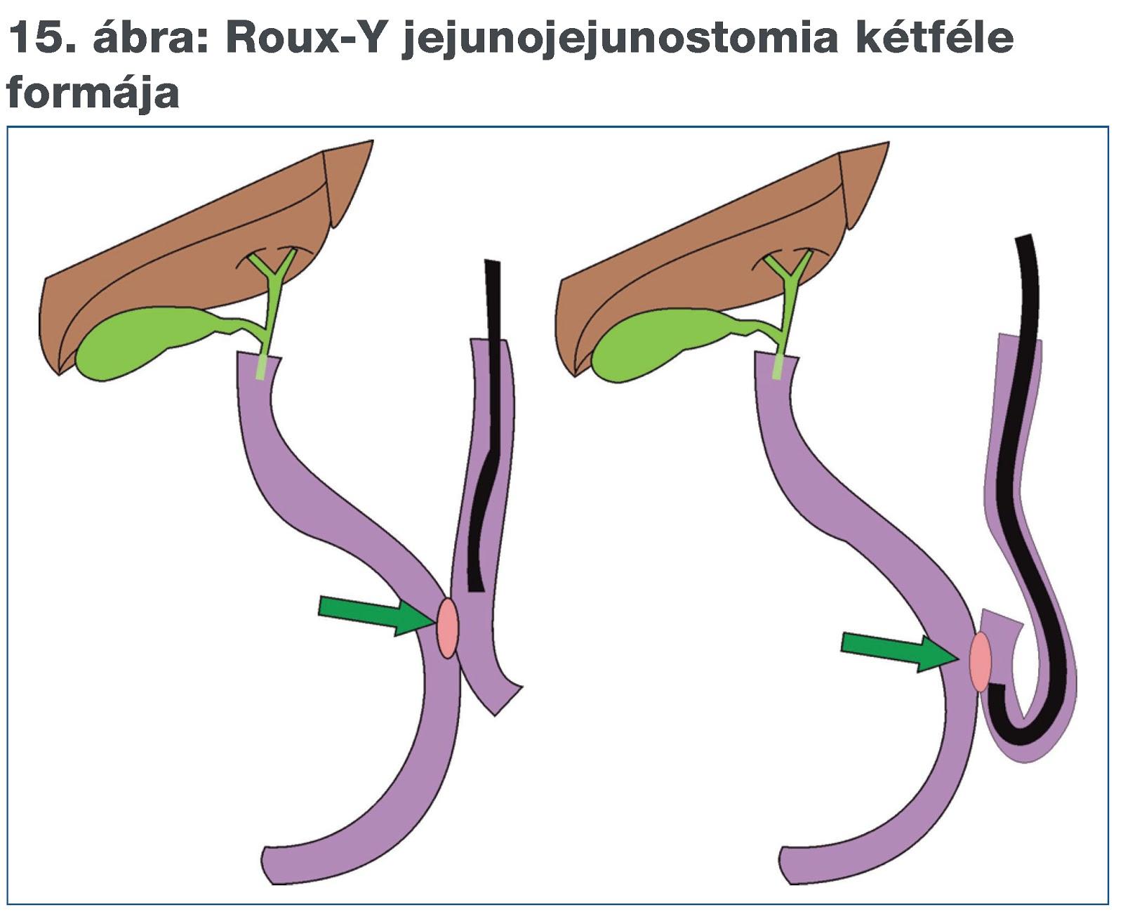 jejunostomia - wood scribd braxin