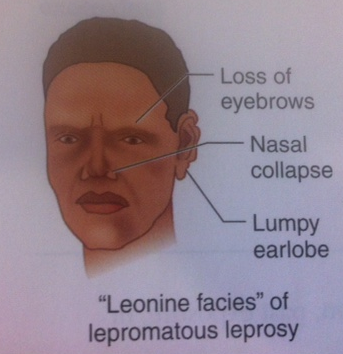 Enfermagem Nossa Vida: Hanseníase