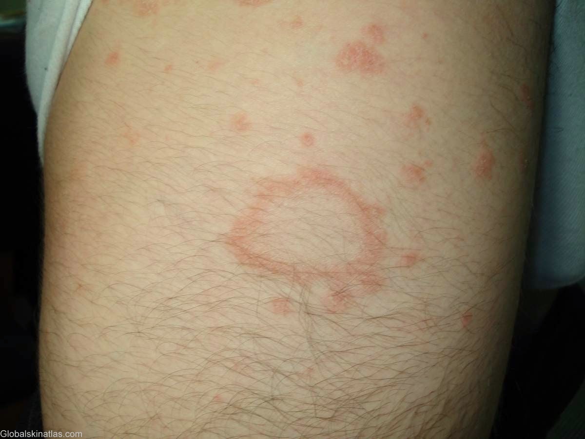 SKIN DISEASE TYPES: Pityriasis rosea (Skin Disease Type)