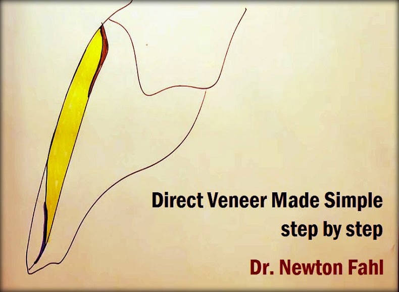 DIRECT COMPOSITE VENEER Step by Step - Dr. Newton Fahl - Odonto-Tv