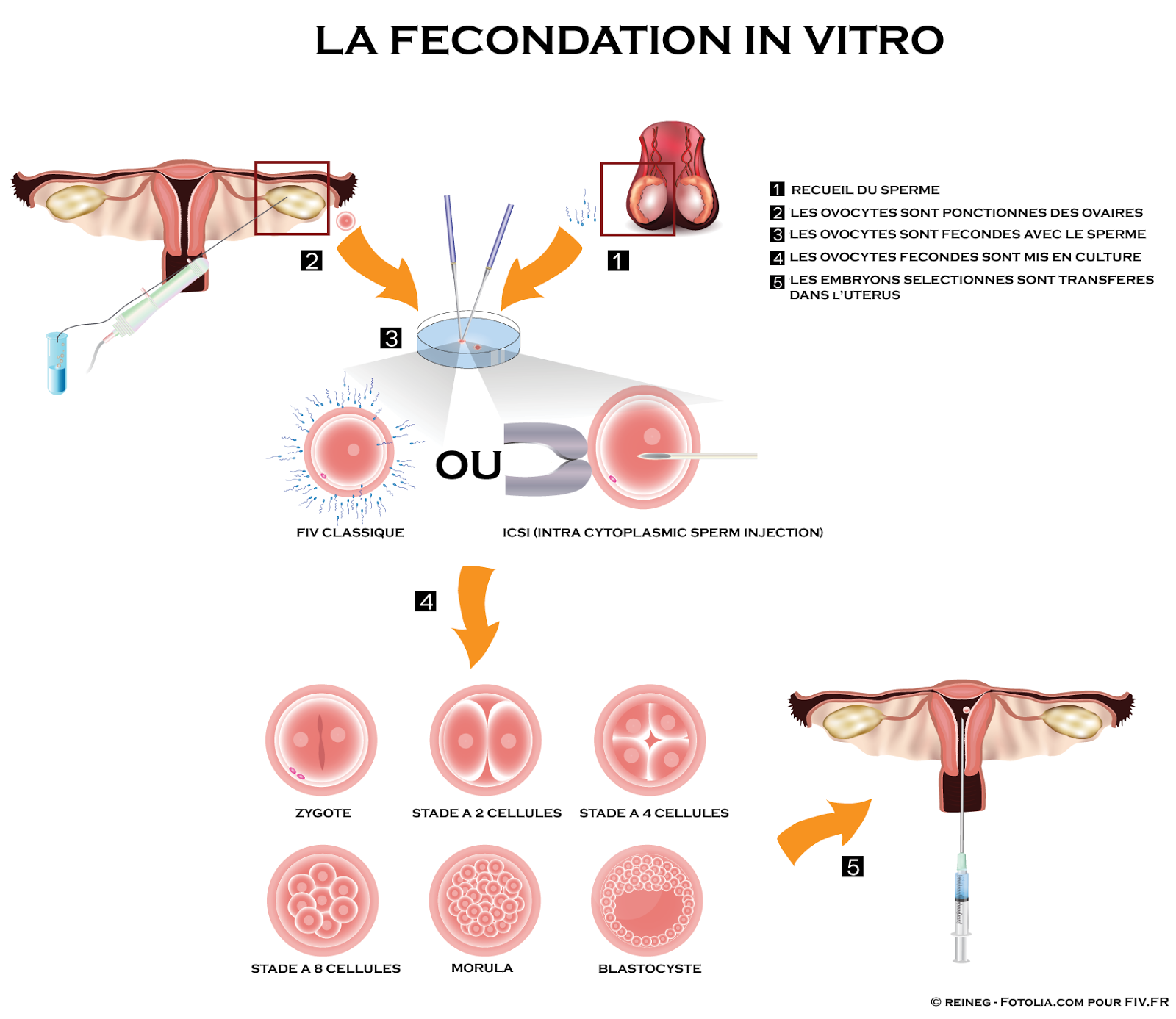 La fécondation in vitro ~ Etudes des sciences de la vie