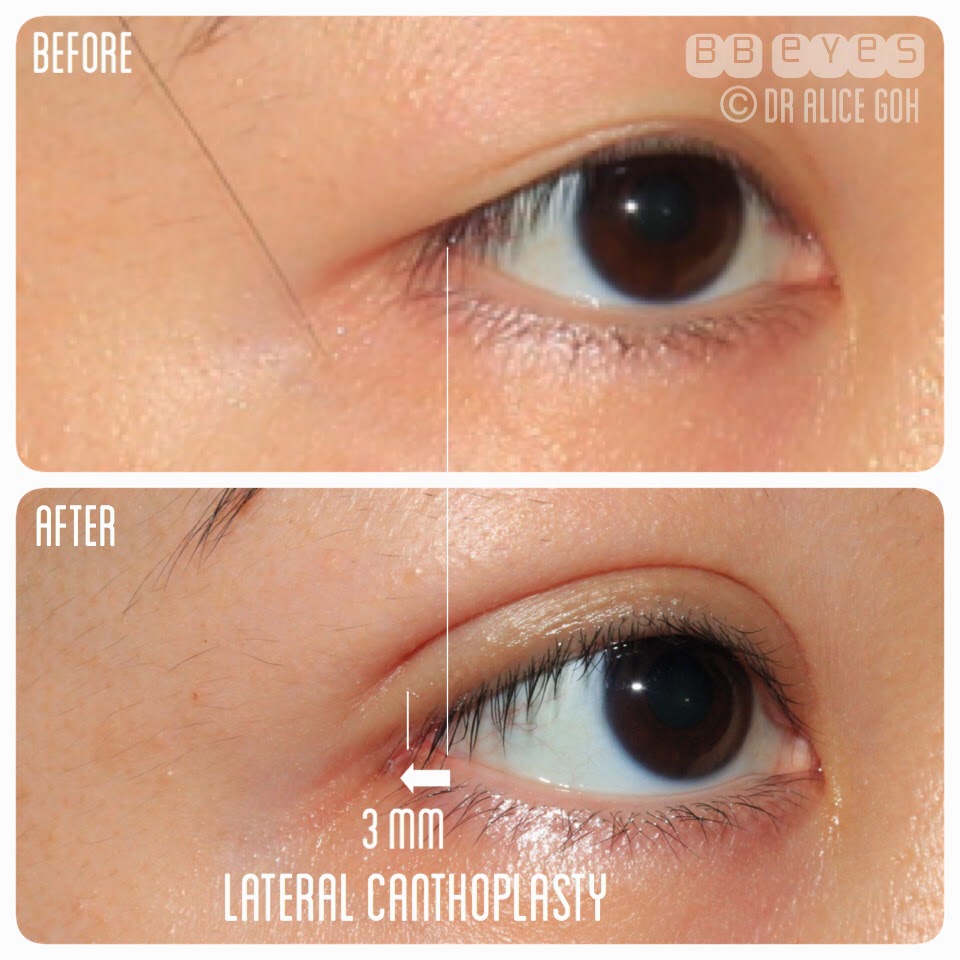 Dr. Alice Goh: Doctor, Can you make my eyelids longer?