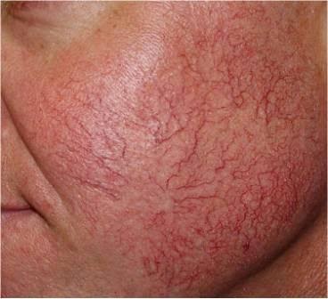 Estética e Autoestima: Telangiectasias - Veias Avermelhadas