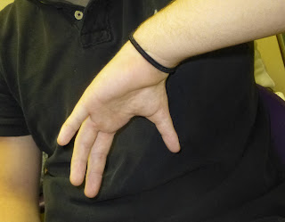 Pollicization at 15 years | Congenital Hand and Arm Differences ...