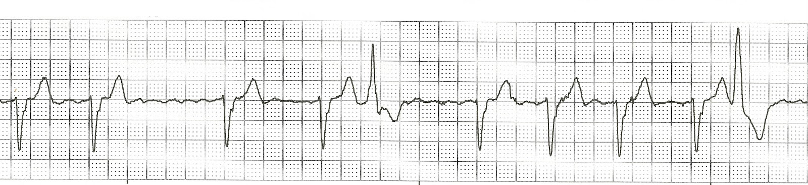 EKG Rhythm Strip Quiz 90