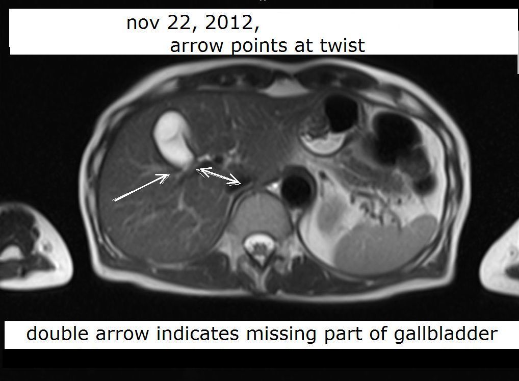 hourglass gallbladder