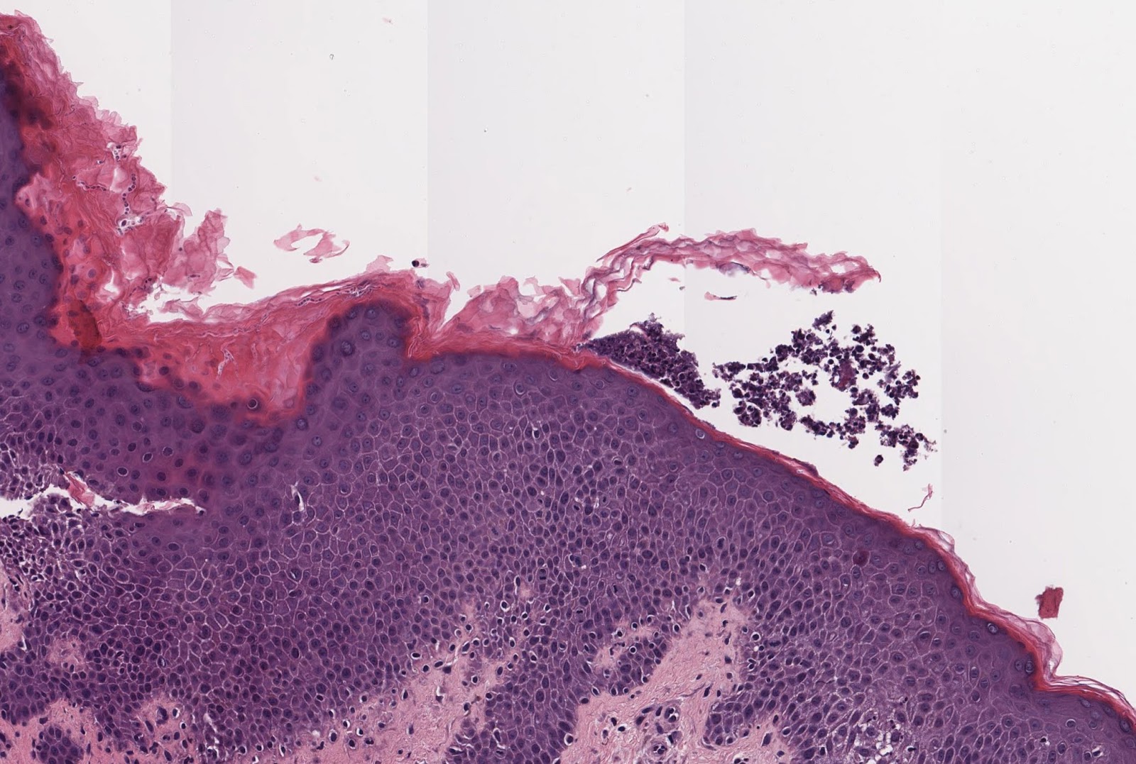 Differential Diagnosis in Dermatopathology: 2014