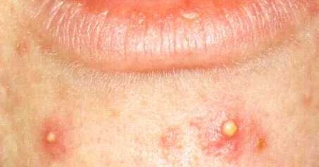 916SKIN - ACNE SKIN & WELLNESS CLINIC: HOW TO TREAT A PUSTULE...