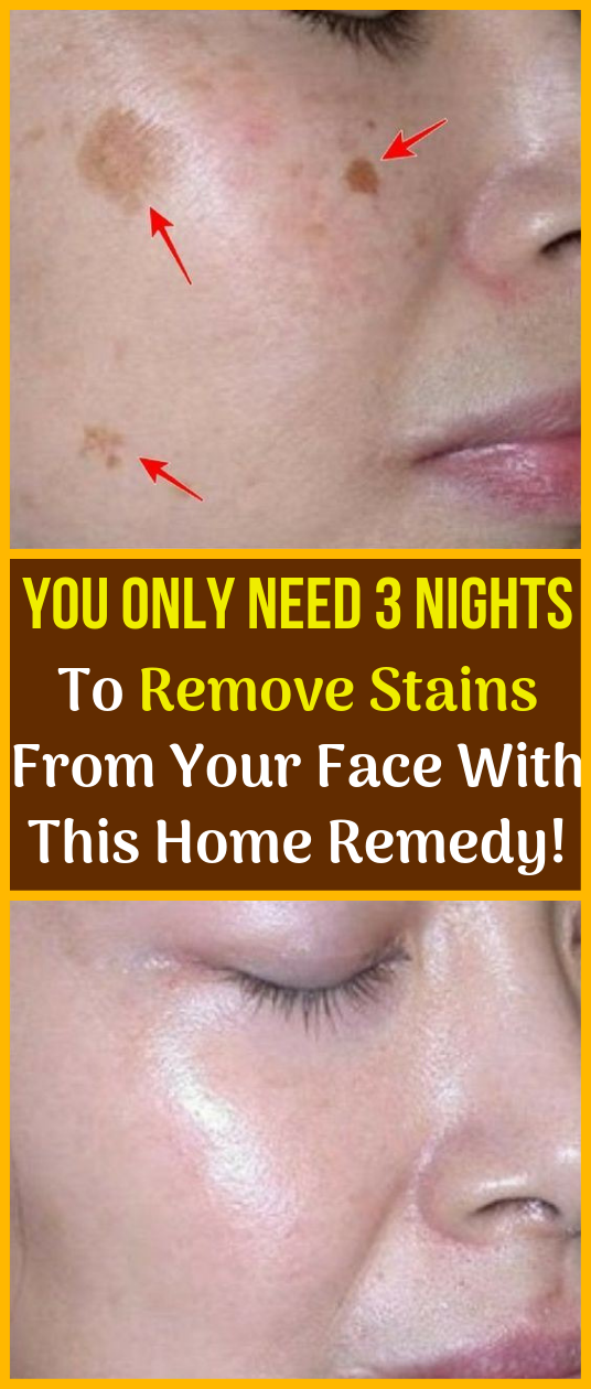 You Only Need 3 Nights To Remove Stains From Your Face With This Home ...