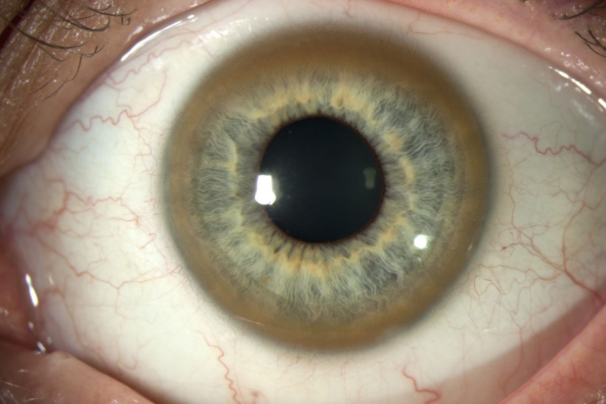 Kayser Fleischer Rings Slit Lamp