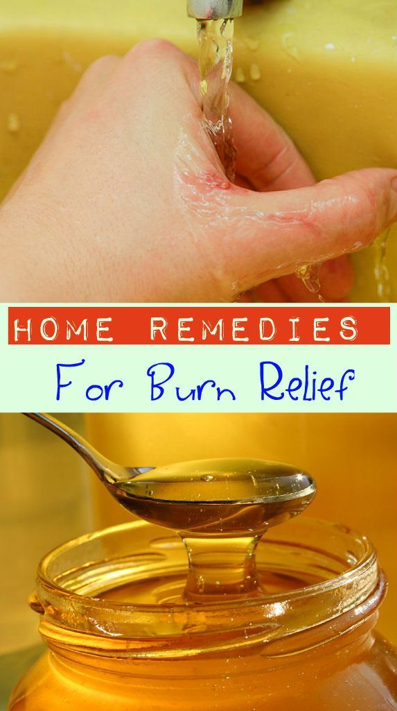 5 Home Remedies for Burns