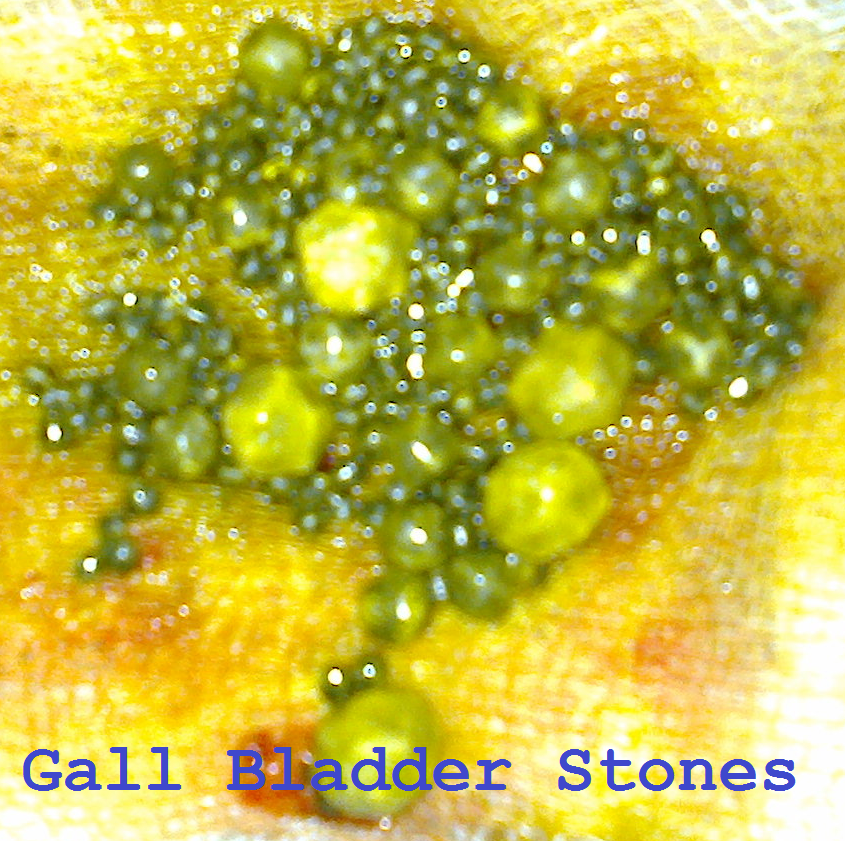 Introduction of Gallbladder Stones (Cholelithiasis) « General Surgical ...