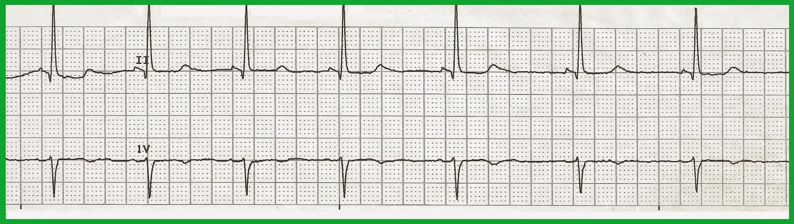 EKG Rhythm Strip Quiz 189
