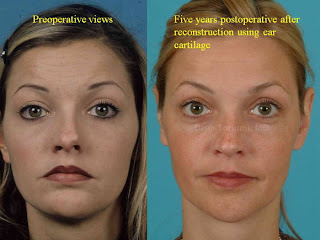 Dr. Dean Toriumi Reviews: Secondary Rhinoplasty surgeries