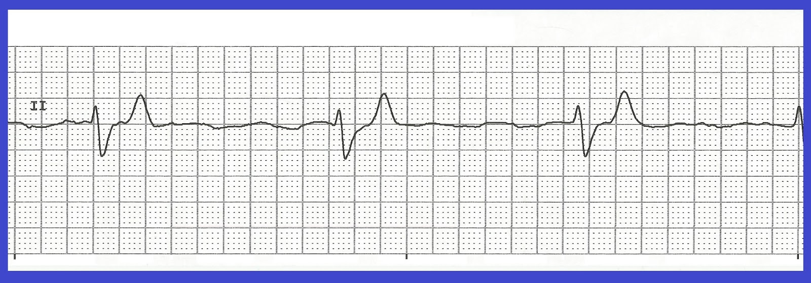 Accelerated Idioventricular Rhythm; AIVR