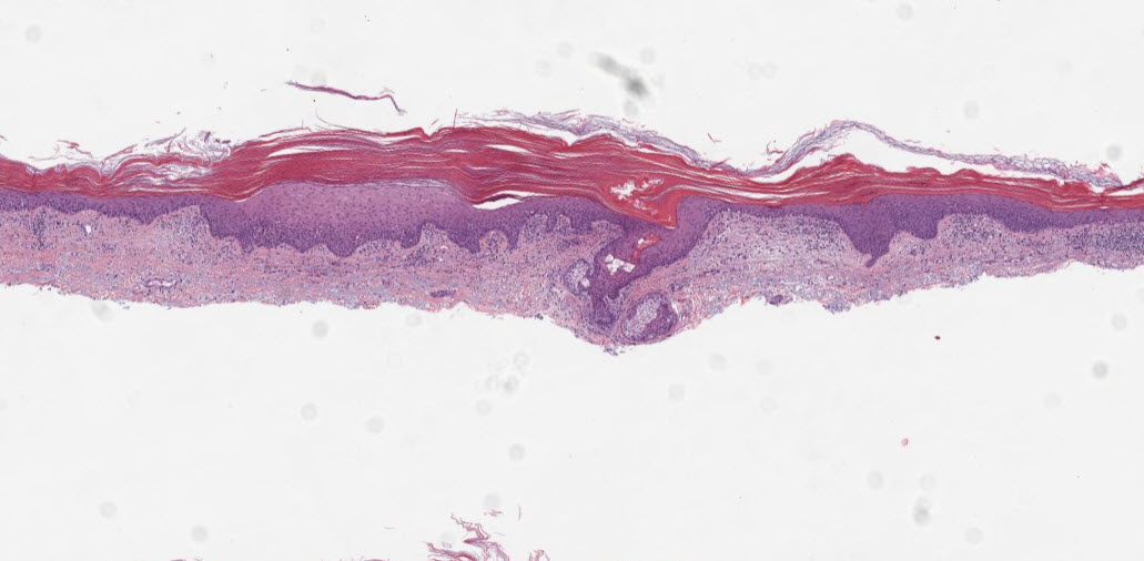 Differential Diagnosis in Dermatopathology: 2014