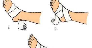 9A Hälsoblogg i ämnet Idrott & Hälsa: Idrottsskada-Stukad fot