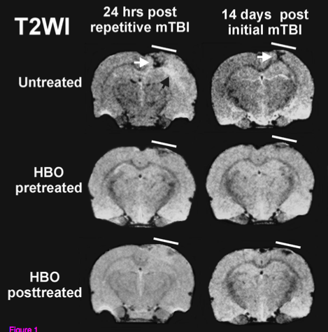 O2.0 - hyperbaric oxygen therapy news: HBOT for TBI: The Loma Linda Review