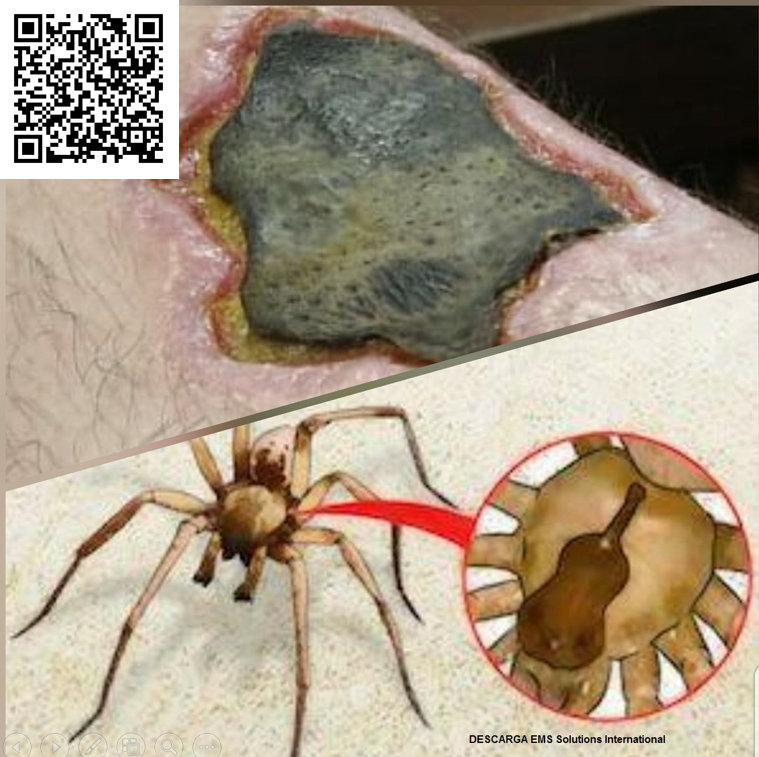 EMS SOLUTIONS INTERNATIONAL by @DrRamonReyesMD marca registrada: ARAÑA ...