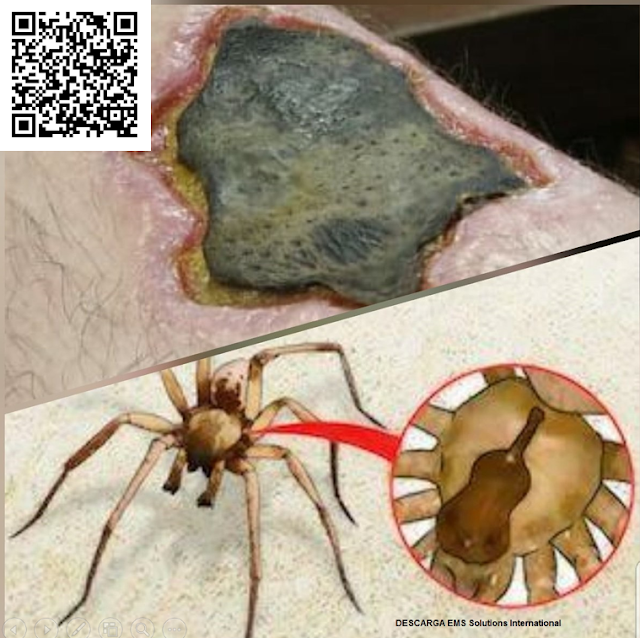 EMS SOLUTIONS INTERNATIONAL by @DrRamonReyesMD marca registrada: ARAÑA ...