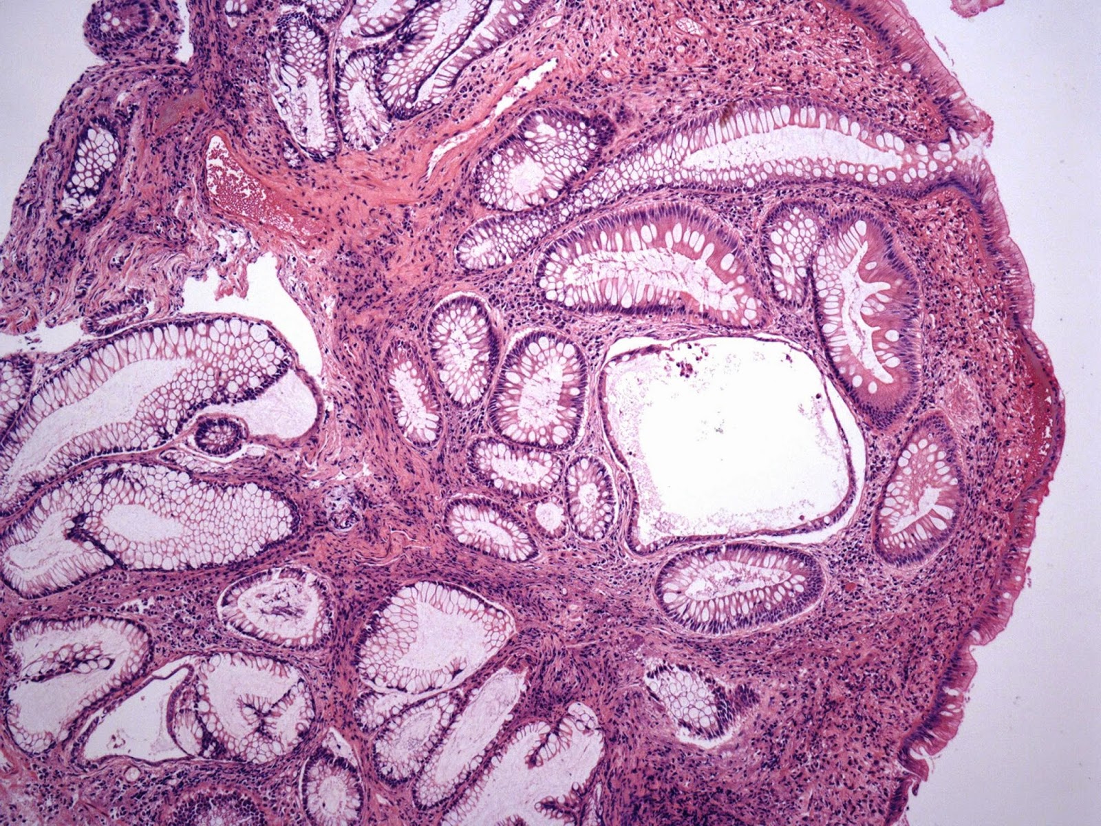 GASTROINTESTINAL AND LIVER HISTOLOGY PATHOLOGY ATLAS: COLON: JUVENILE POLYP