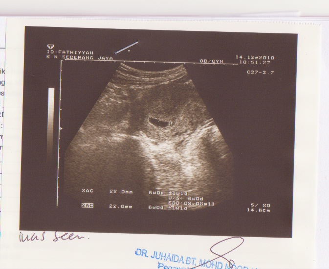 kisah hidupku...: Mengesahkan kehamilan
