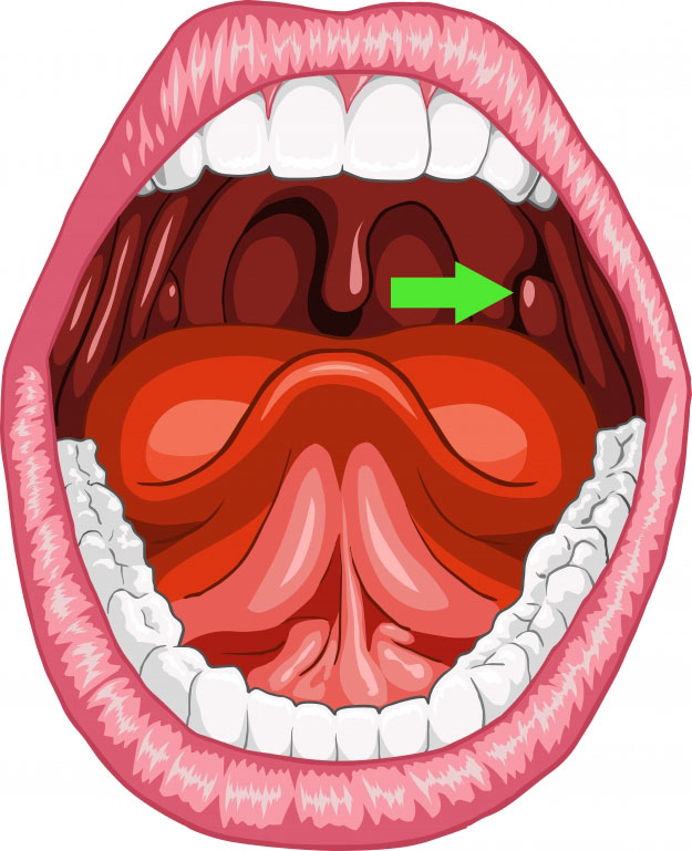 Health Problems What Are The White Spots On The Throat health-problems-what-are-the-white-spots-on-the-throat