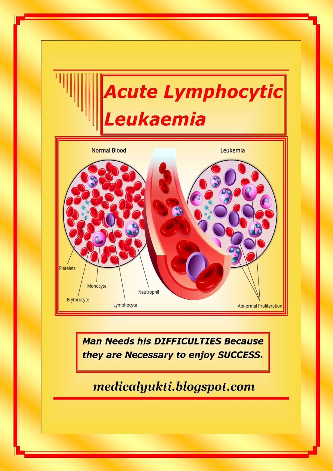 Acute Lymphocytic Leukaemia - Medical Yukti