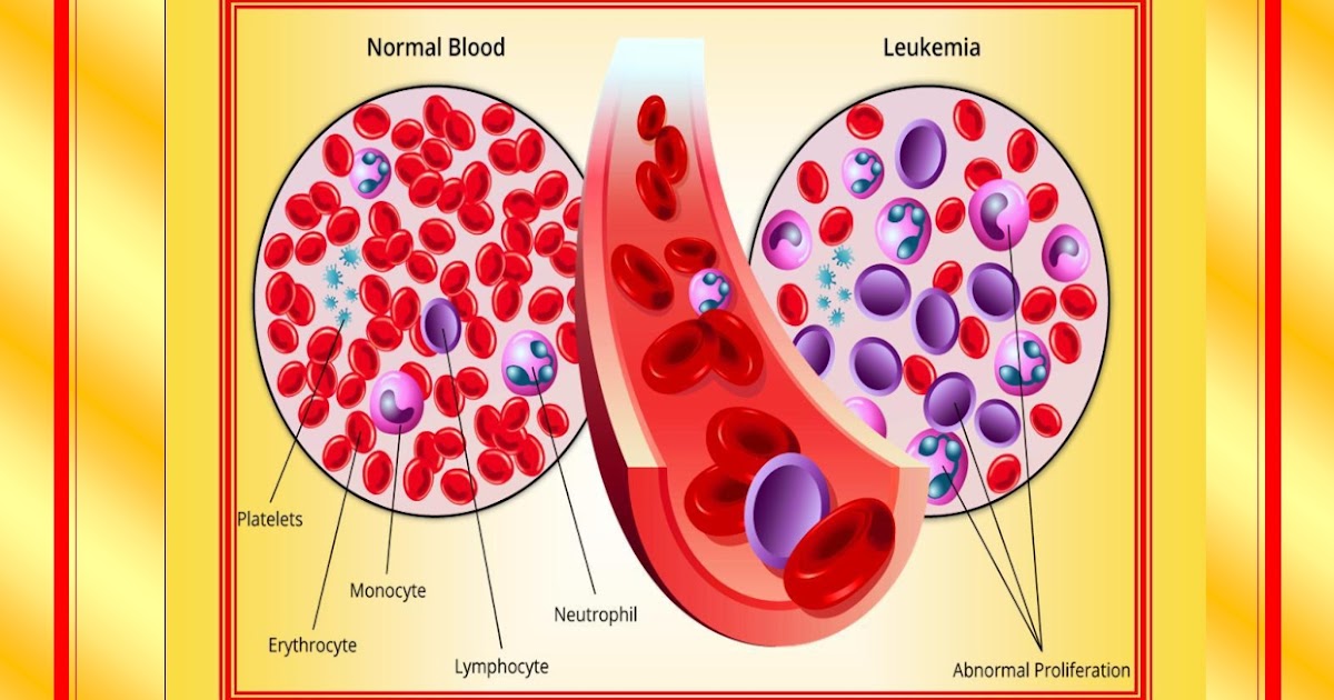 Acute Lymphocytic Leukaemia - Medical Yukti