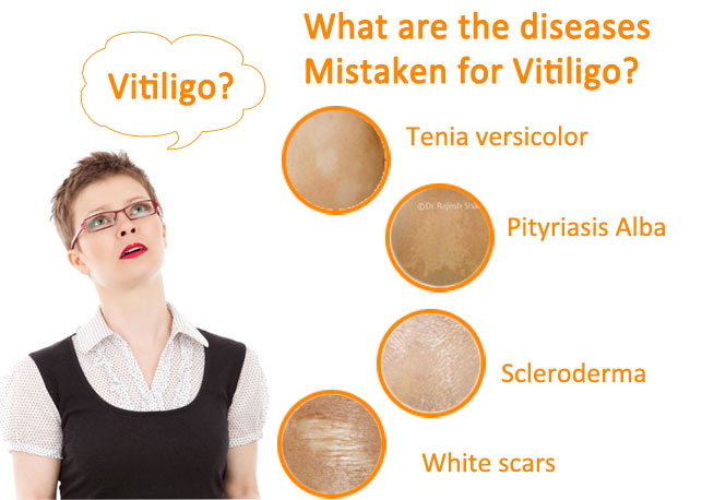 How Vitiligo Affects An Individual Life?: Symptoms and Causes of Leucoderma
