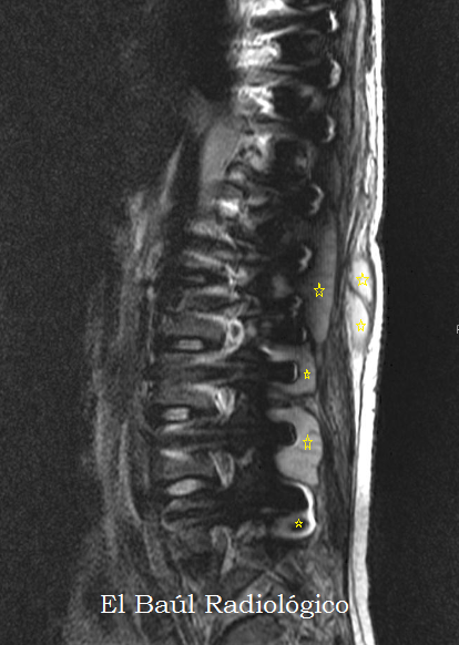 El Baúl Radiológico: SEROMAS POSTQUIRÚRGICOS PARAVERTEBRALES (Lumbar ...