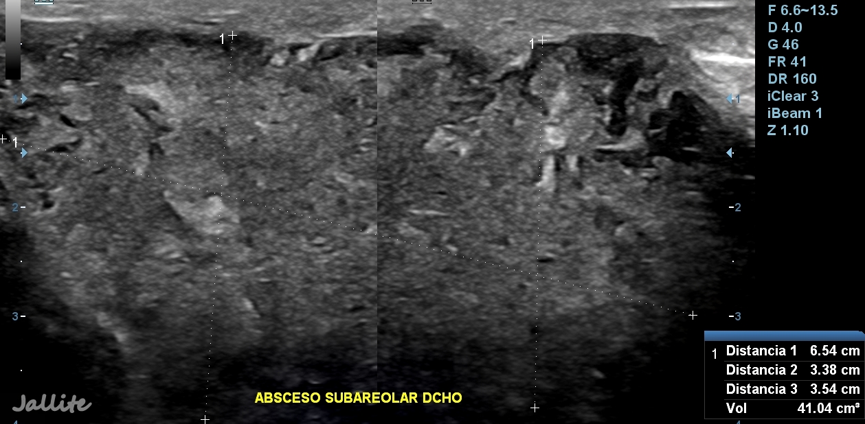 Abscesos Mamarios Multiples