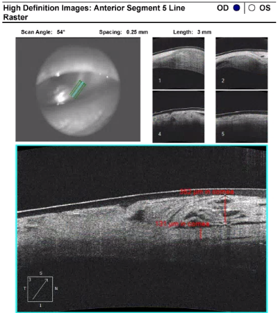 Cornea and Anterior Segment Imaging: Peripheral Ulcerative Keratitis