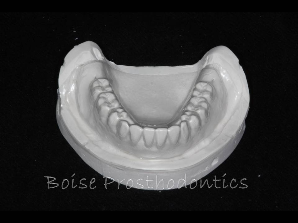 Boise Idaho Prosthodontics: Picture Sequence of Maxillary Complete ...