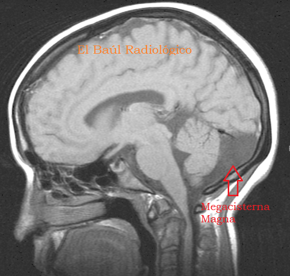 El Baúl Radiológico: ASPECTO DE LA CISTERNA MAGNA EN TOMOGRAFÍA ...