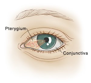 Pterygium, Cause, Symptoms and Treatment - Eye Health Nepal