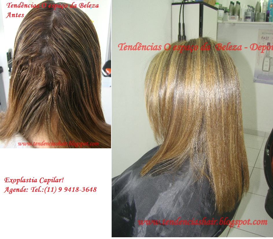 Tendências Hair: Exoplastia Capilar