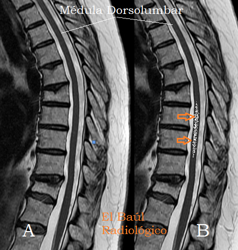 El Baúl Radiológico: EDEMA DE LA MÉDULA ESPINAL: HALLAZGOS EN IRM ...