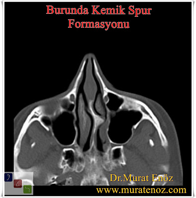 Health Zone Turkey: Nasal Bone Spur - Symptoms, Diagnosis, Treatment