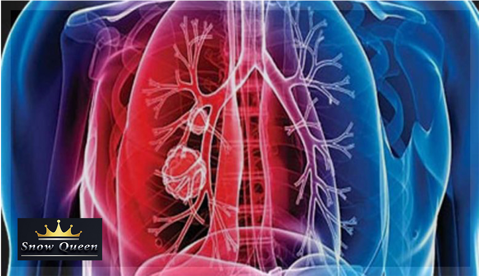 Causes of pulmonary tuberculosis symptoms and how to treat