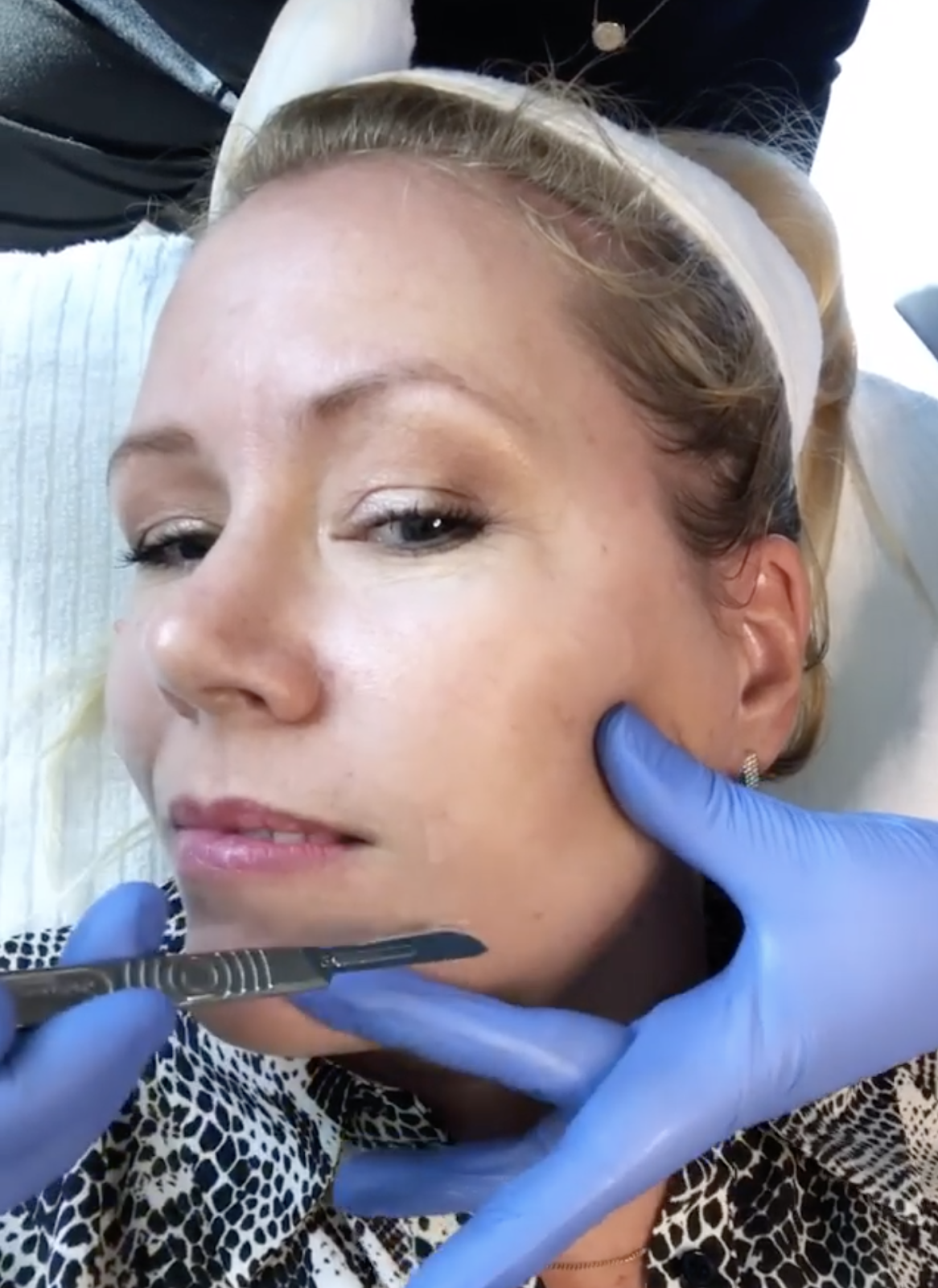 Microdermabrasion vs Dermaplaning: which one is better?