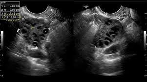 BioLogic: PCOS-Causes, Symptoms, Diagnosis and Treatment