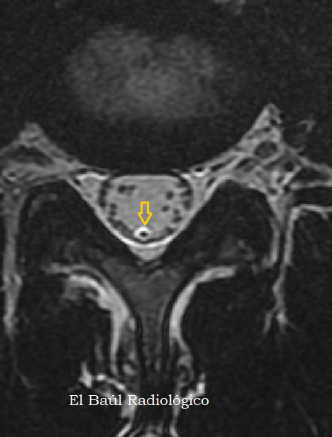 El Baúl Radiológico: LIPOMAS DEL "FILUM TERMINALE": HALLAZGOS EN TC y ...