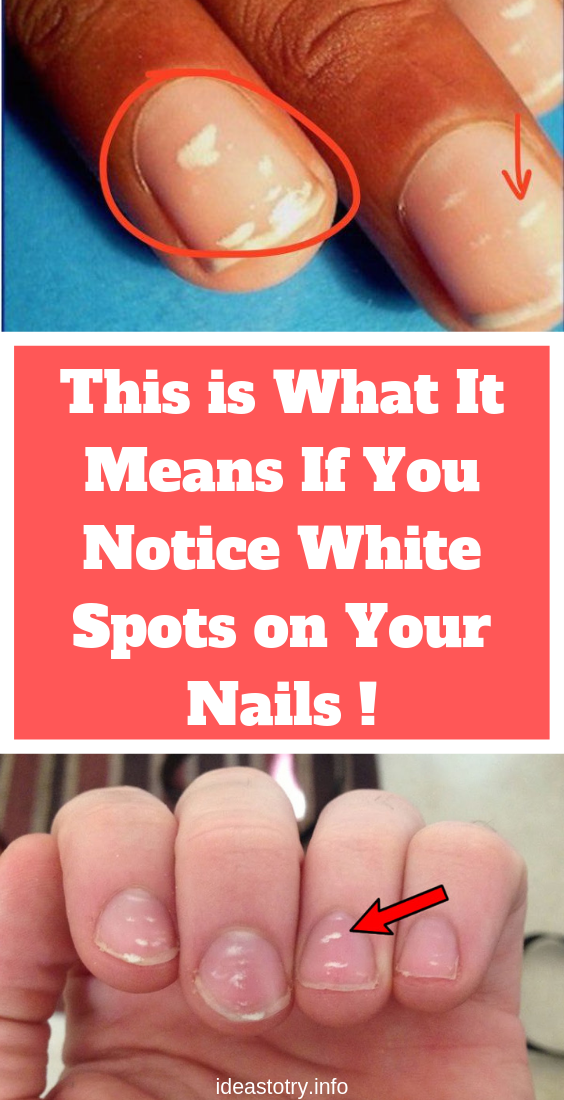 This Is What It Means If You Notice White Spots On Your Nails ! - Draco ...