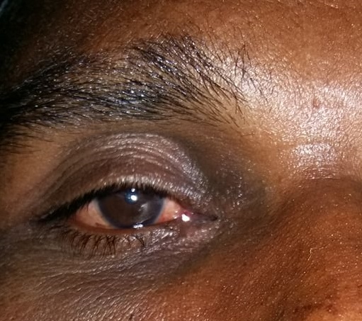 Caruncle Cyst Surgery : Before and After - Eye Health Nepal