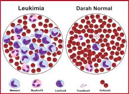 Gejala dan Cara Pengobatan Penyakit Leukimia - klasik klasik